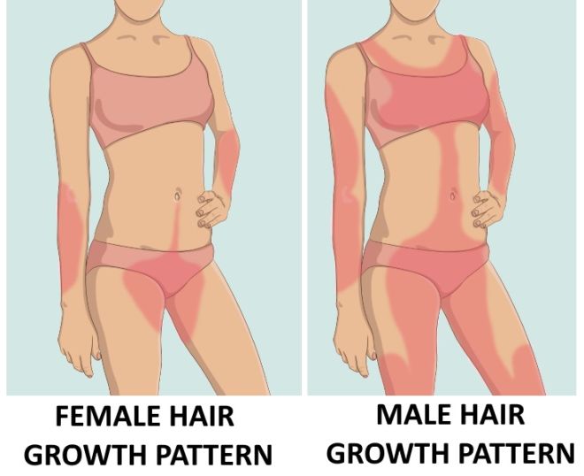 Excess Hair Growth In Women Is A Symptom You Shouldn t Ignore 